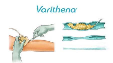 Varicose veins and Superficial venous Disease - Treatment with Varithena